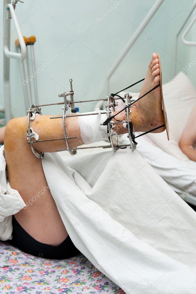 Leg in Ilizarov's external fixator, Ilizarov's apparatus — Stock Photo ...