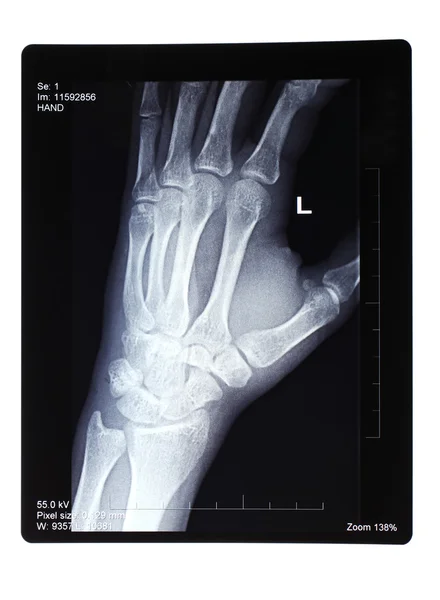 Xray Broken Hand
