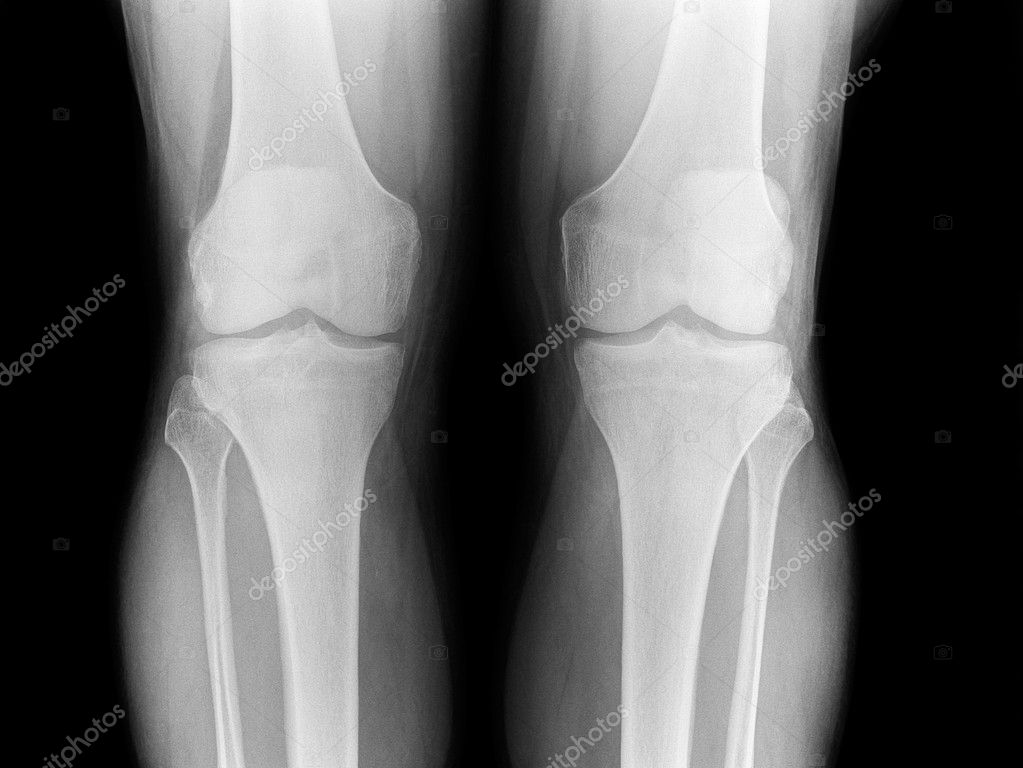 X-ray of the knee — Stock Photo © ramvseb #10392687