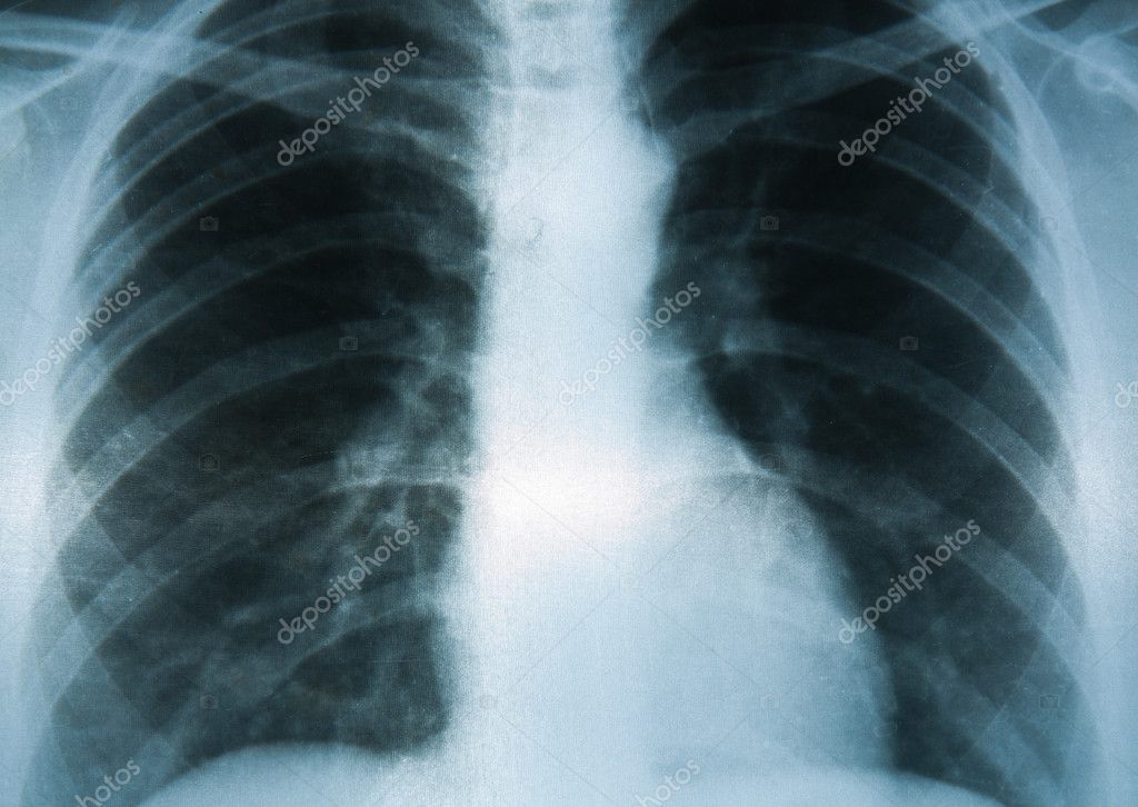 Chest X-ray image — Stock Photo © Pavel_Lysenko #9324827