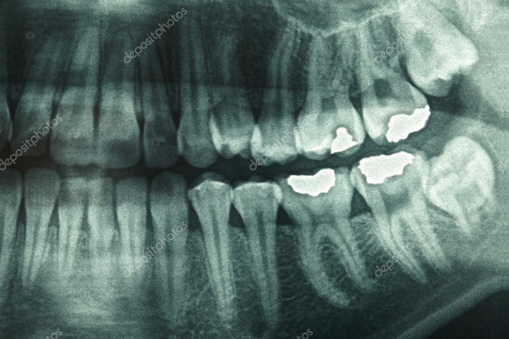 Dental xray Stock Photo by ©AndreaA. 8483394